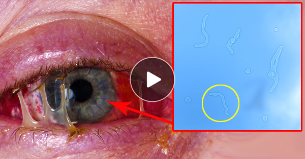 Have you ever noticed those worm-like floaters in your eyes?