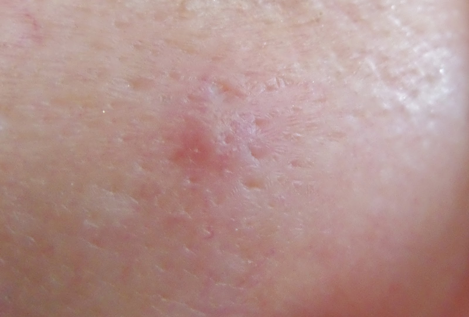 Dermatofibroma On Leg