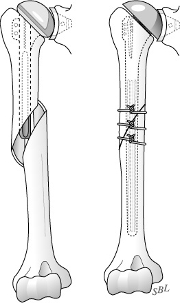 UW Shoulder and Elbow Academy: Revision surgery for failed shoulder ...