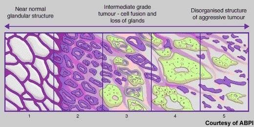 Temas sobre el cancér - Diagnosticos - Tratamientos - Sintomas: Un ...
