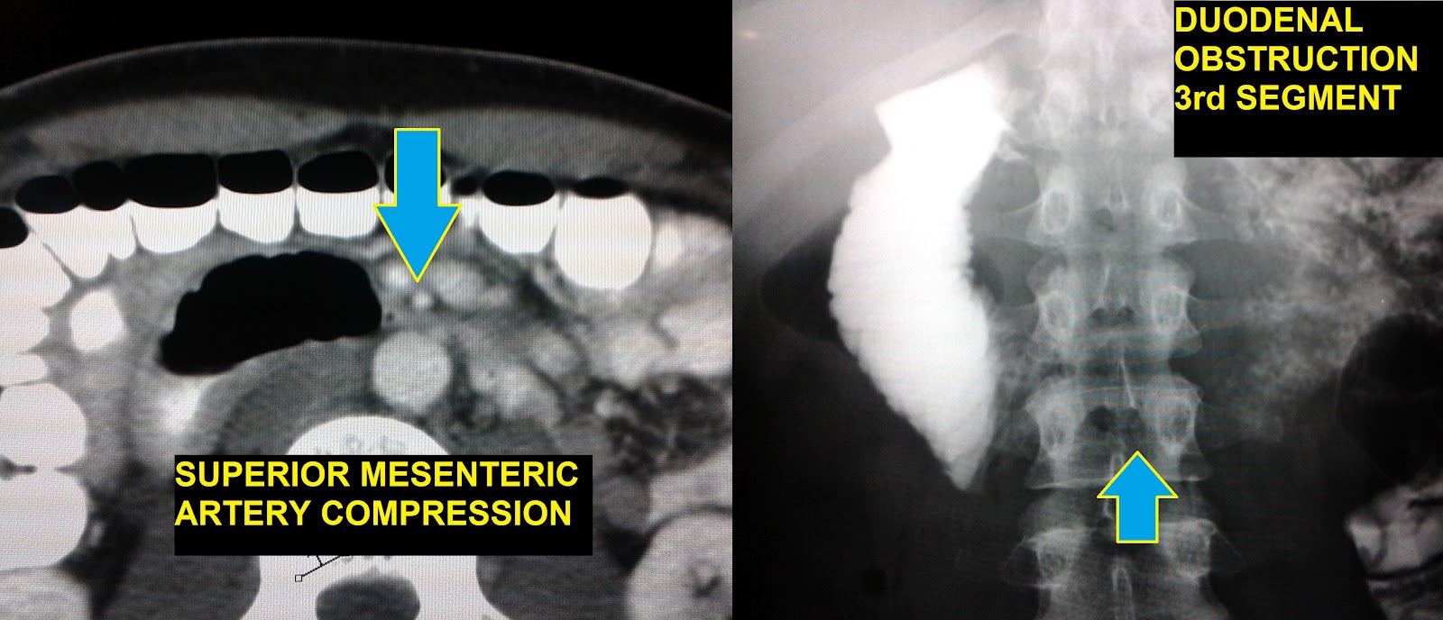 POINT OF VIEW: DX: Superior Mesenteric Artery (Wilkie's) Syndrome