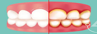 SATPEL RADANG GUSI (GINGIVITIS) - Seputar Kesehatan Gigi