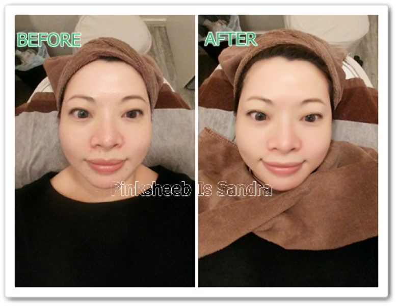 A-PLUS Beauty: (Blogger文分享)改善敏感泛紅肌膚。XEO LASER GENESIS 微秒激光療程 @A-PLUS ...