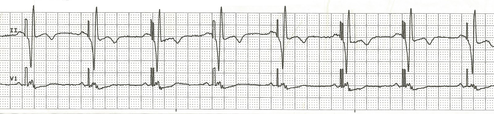 EKG Rhythm Strips 75