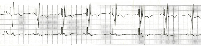 EKG Rhythm Strips 75