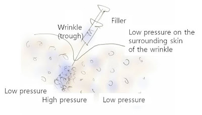 Dr. Lee Breast augmentation Korea: Treating indian band | KIES-U ...