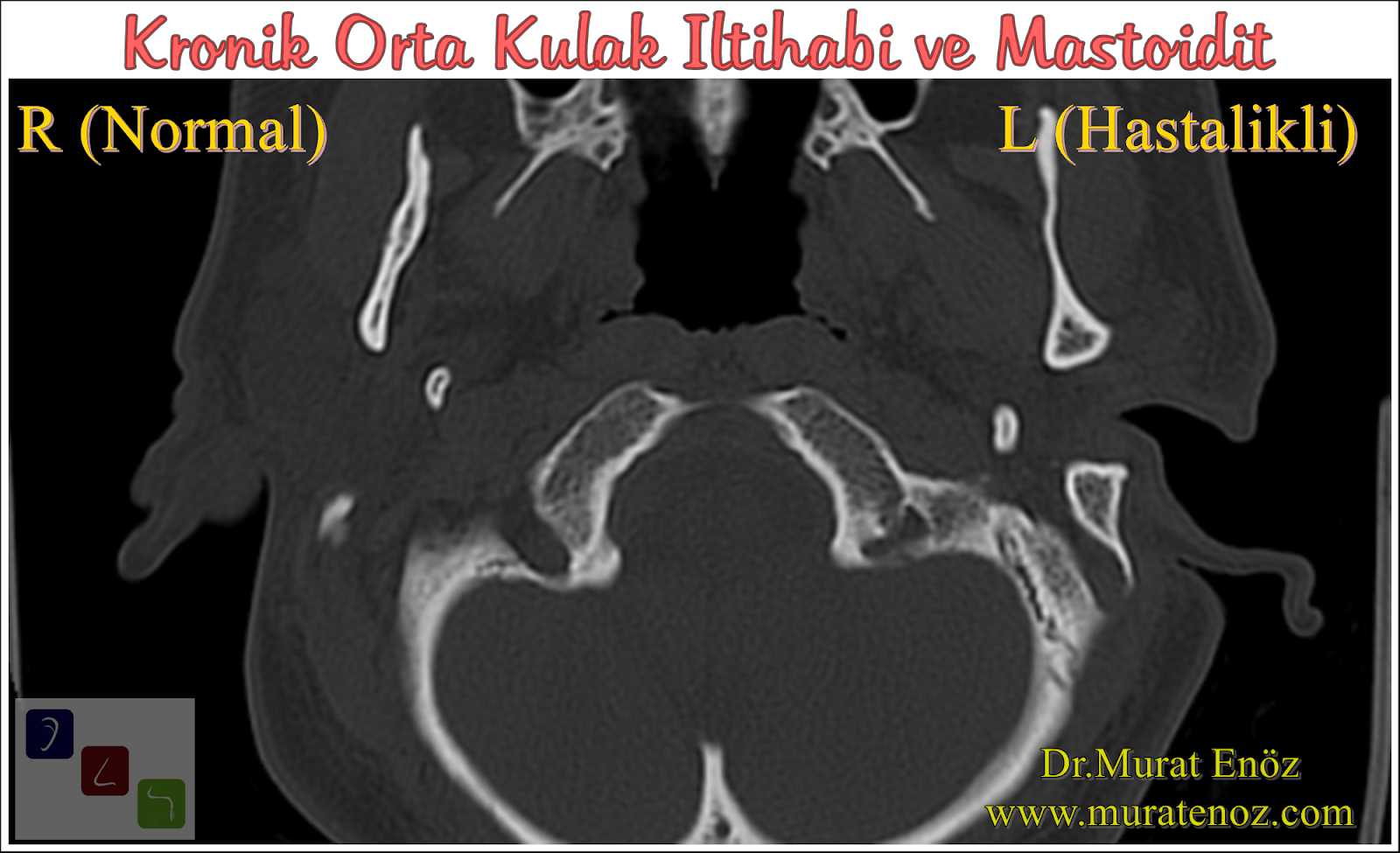 Mastoidit Tanımı, Nedenleri, Belirtileri ve Tedavisi