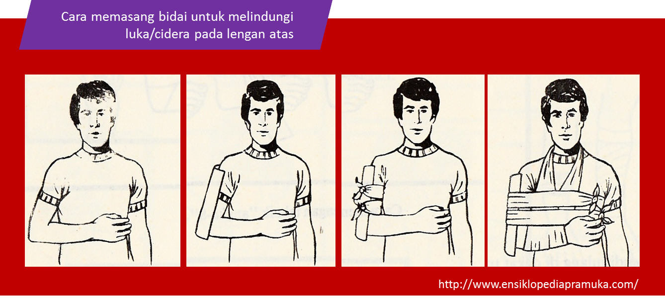 PPPK : Jenis dan Cara Pembidaian (Splenting)