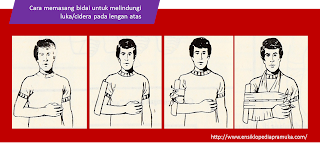 Teknik - Teknik Pembidaian: Pembidaian