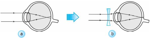 Bagian-bagian Mata sebagai Alat Optik serta Macam-macam Jenis Penyakit ...