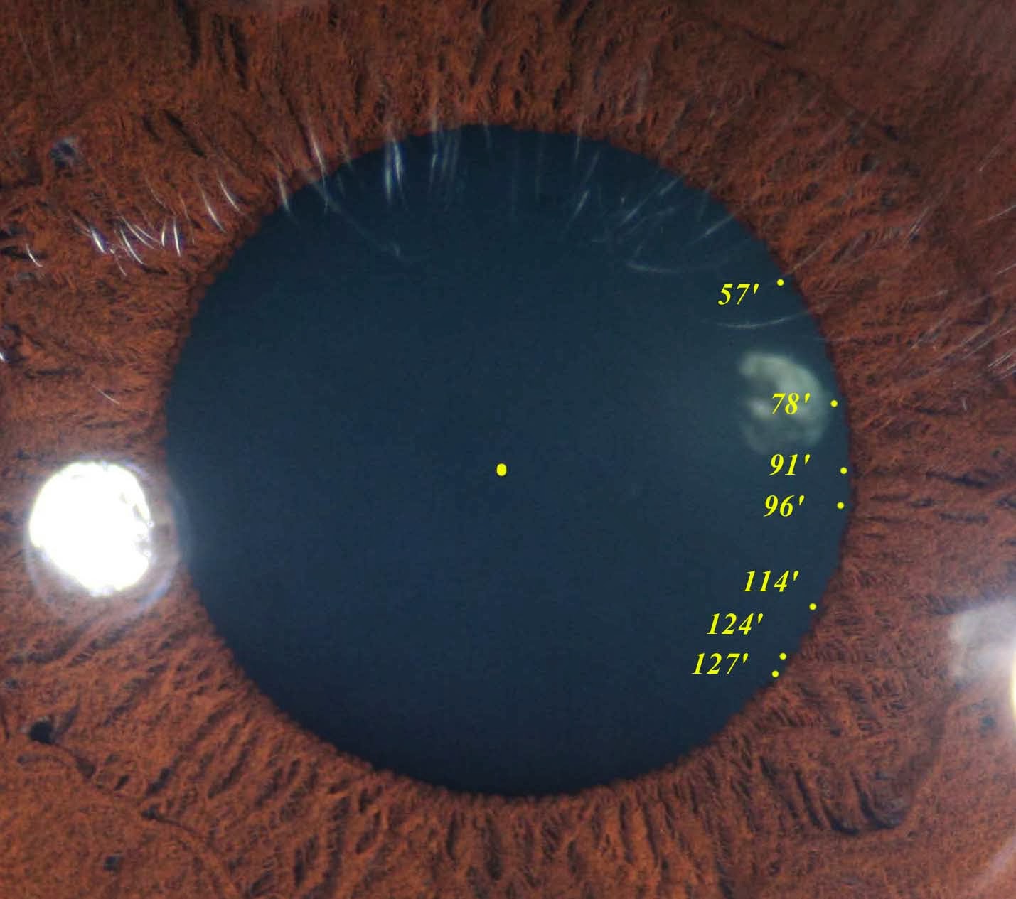 Modern & Multidimensional Iridology: IPB, Pupillary Zone, Collarette ...