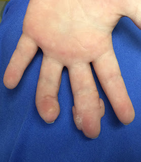 Finger Masses | Congenital Hand and Arm Differences | Washington ...