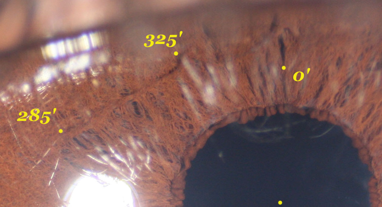 Modern & Multidimensional Iridology: Inner Pupillary Border, Pupil ...