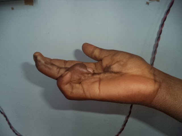 The Learner: Post-burn contracture - Hand