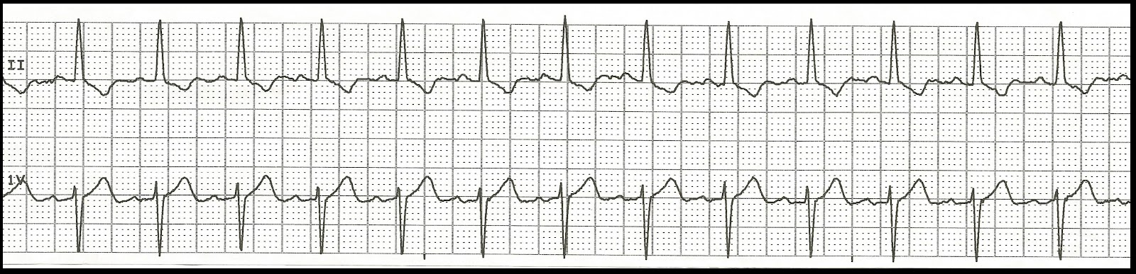 Practice ECG Rhythm Strips 100