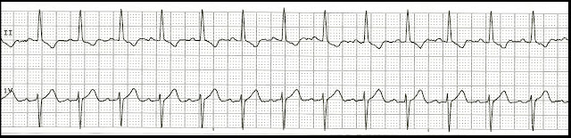 Practice ECG Rhythm Strips 100