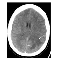 Ners Education: Asuhan Keperawatan Abses Otak