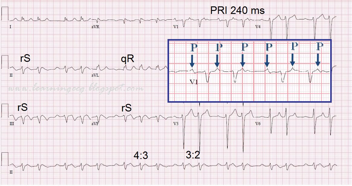 ECG Rhythms: The group-beating