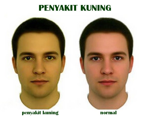 Waspadalah !! Penyebab Penyakit Kuning Pada Orang Dewasa - Apotikid.com