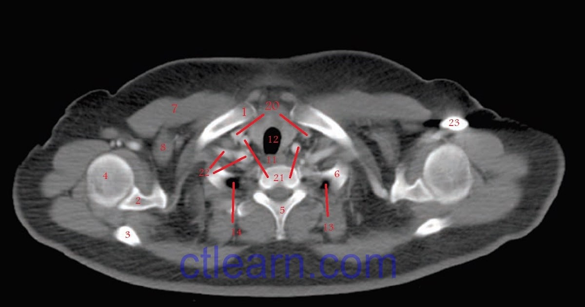 Anatomy CT Axial Chest