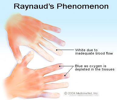 I HATE Postural Orthostatic Tachycardia : What is Raynaud's (ray-NOHDZ ...