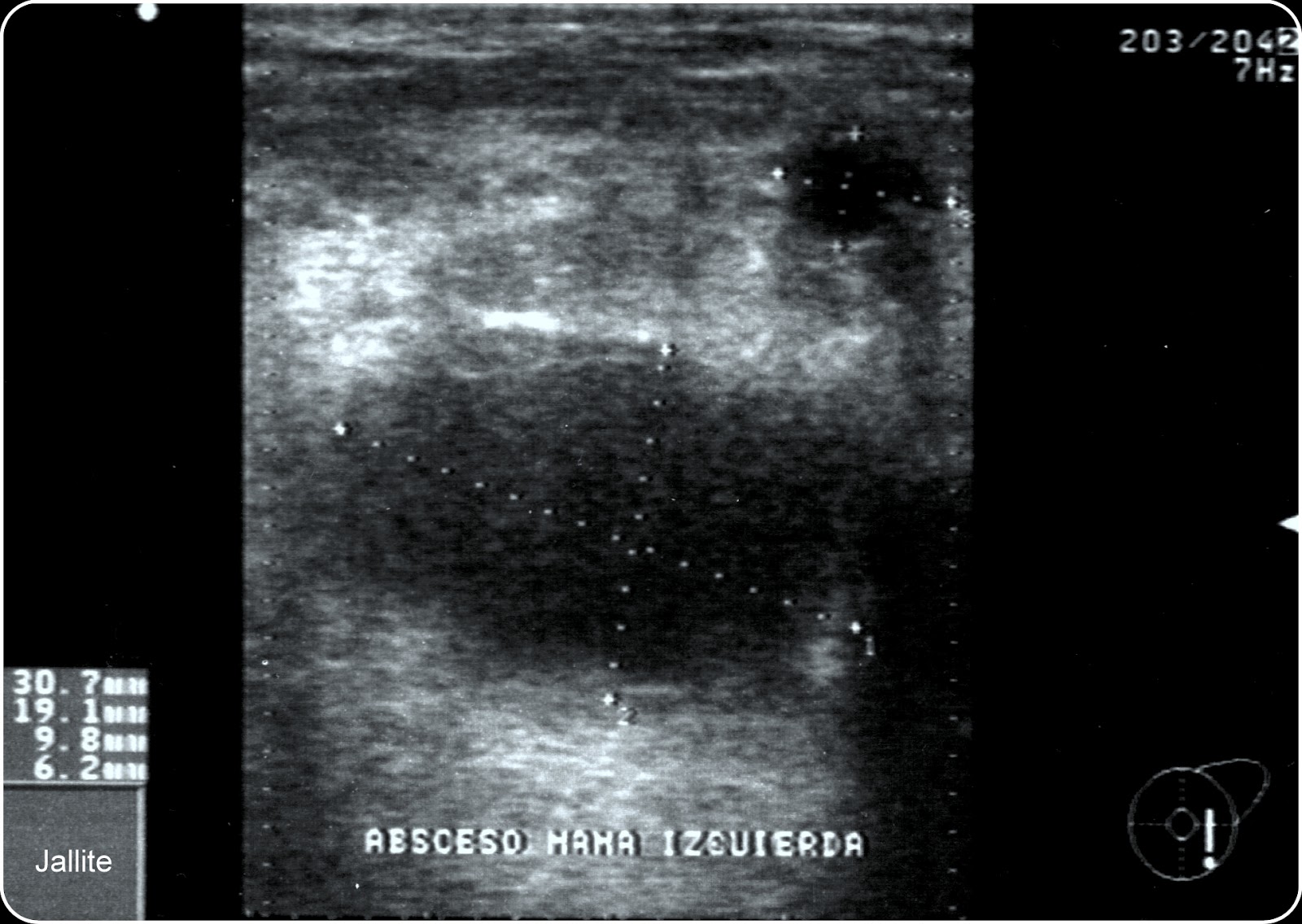 Absceso & Quistes & Fibroadenomas Mamas