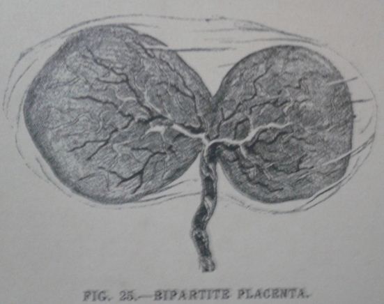 Placenta Bipartite