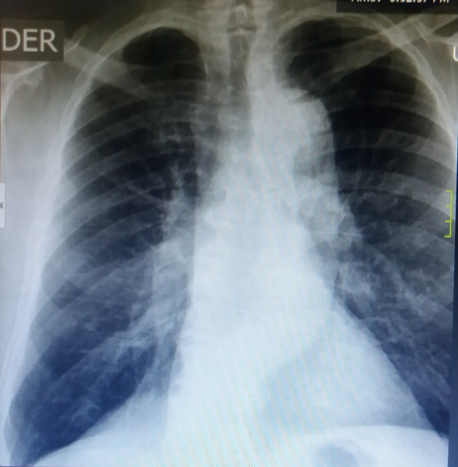 MEDICINA: EPOC EXACERBADO SOBREINFECTADO