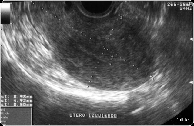 Útero Doble o Didelfos