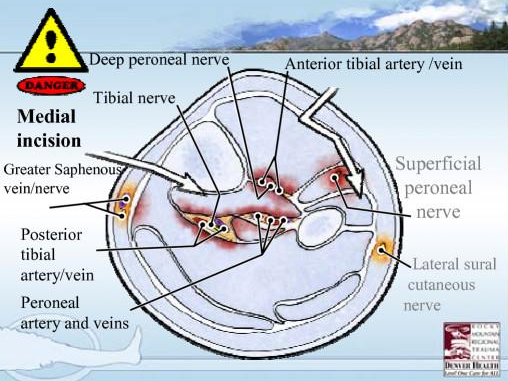 骨科筆記: FASCIOTOMY
