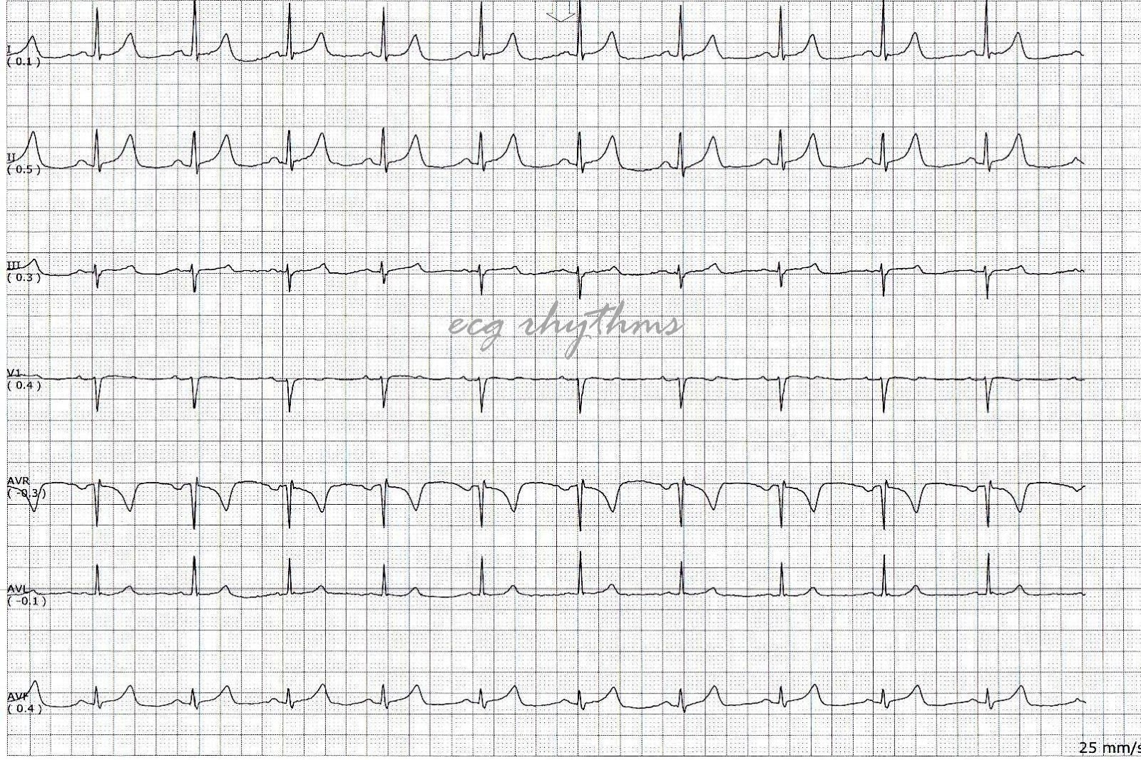Ecg Interpretation