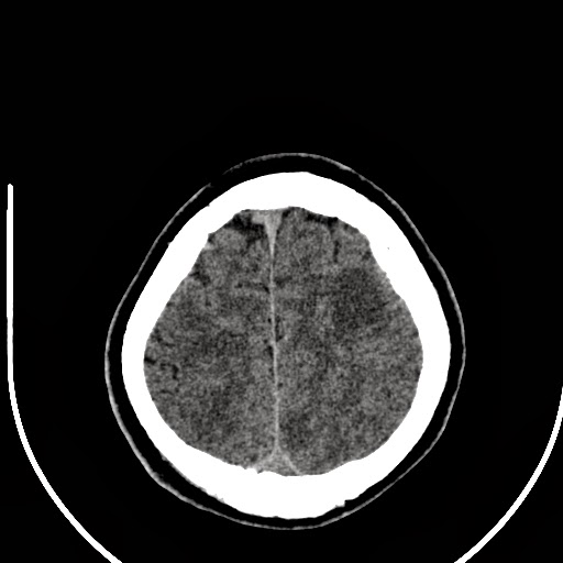Ultimate Radiology : Bilateral thalamic and cerebellar hypodensity
