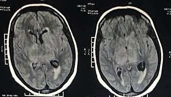 Deep cerebral Venous Thrombosis-MRI - Sumer's Radiology Blog