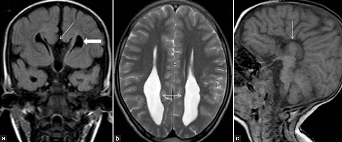 Colpocefalia - As Doenças Raras