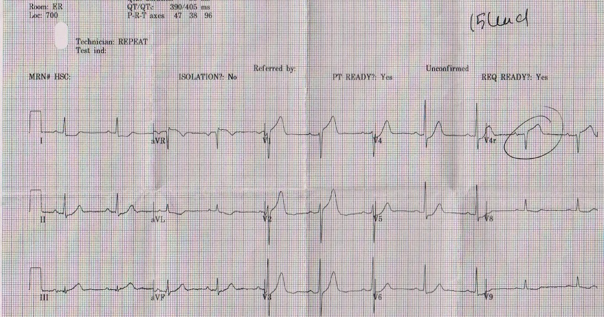 Dr. Smith's ECG Blog: Septal STEMI with ST elevation in V1 and V4R, and ...