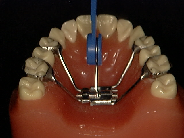 Biggs-Hansen Orthodontics: Smiles Above the Rest: Rapid Palatal Expander