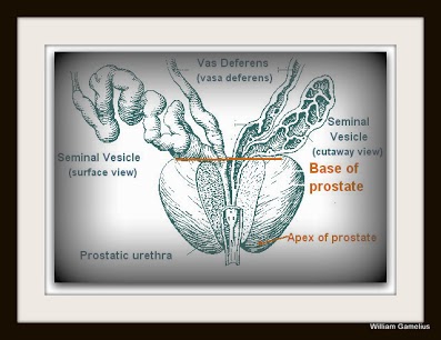Forskning, Debattring. Om olika ämnen.Prostatacancer.Prostatacancer ...
