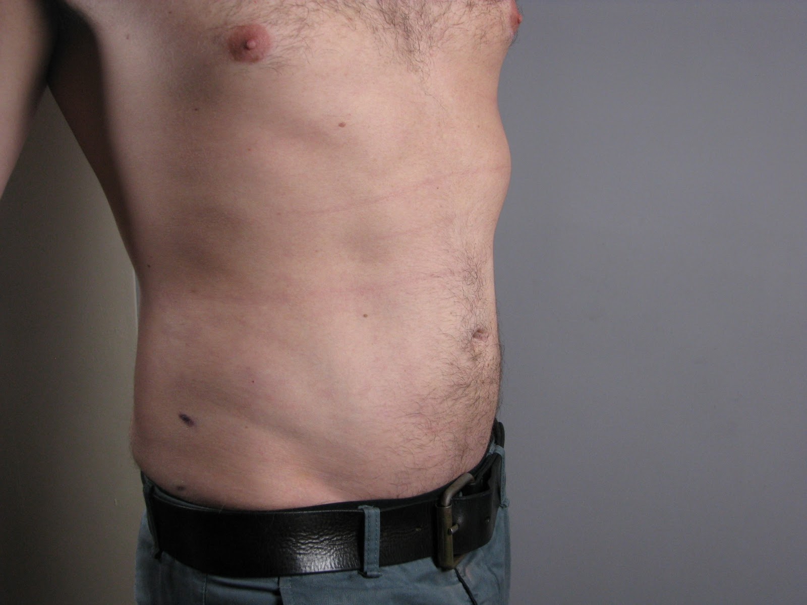 Selston Cosmetic Clinic: Vaser Lipo. Male Abs..Before and After