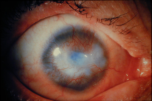 Deformutilation: Corneal Chemical Burns
