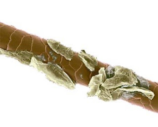 Comenzamos actividades =): DERMATITIS SEBORRÉICA (CASPA)