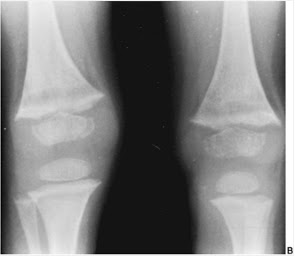ON - RADIOLOGY: Rickets X-ray Before and After vitamin D therapy