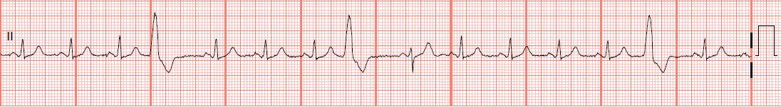 EKG Rhythm Strips 18: Ventricular Ectopy 1