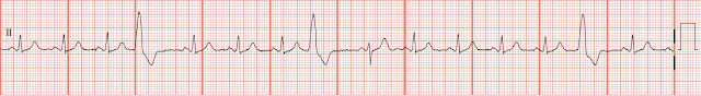 EKG Rhythm Strips 18: Ventricular Ectopy 1