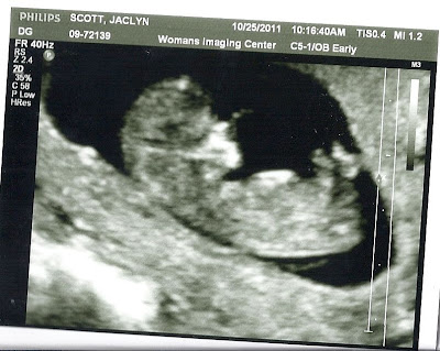 Our Scott Spot: 11 Week Ultrasound