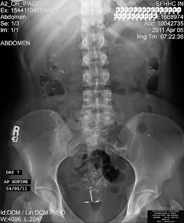Goodbye CI: Sitz Marker Study