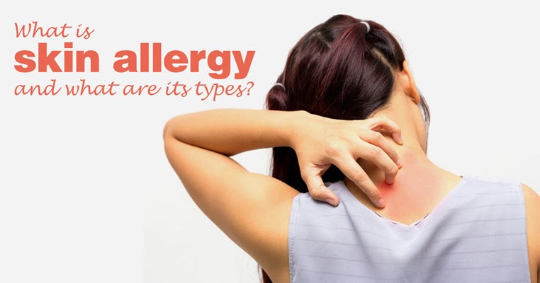 WHAT IS SKIN ALLERGY?