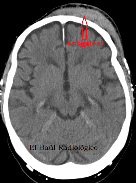 El Baúl Radiológico: 2) HEMATOMA SUBGALEAL: HALLAZGOS EN TOMOGRAFÍA ...