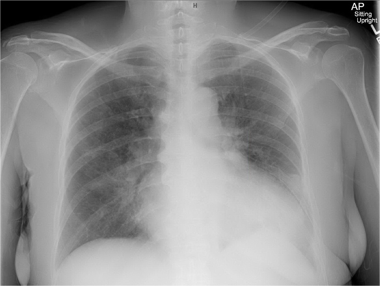 Cardiogenic Pulmonary Edema X Ray
