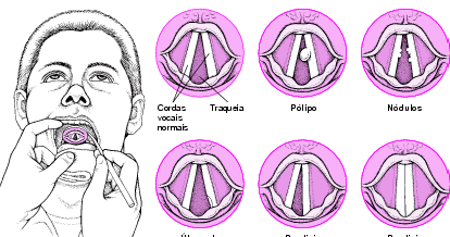 Blog Da Nivea: Ilustrações sobre as cordas vocais