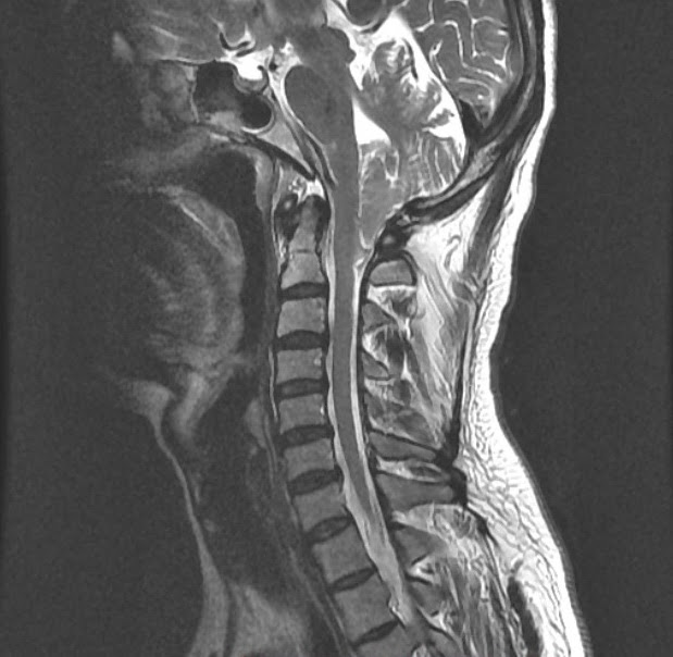 Ultimate Radiology : The Chiari I Malformation